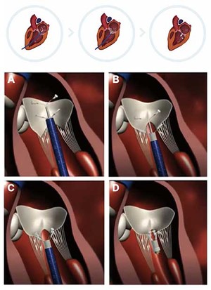 [고려동물메디컬센터_임상 포커스] mmvd와 V-clamp 수술 이야기 그래서, TEER (=V-clamp) 수술이 뭔데? (下 ...